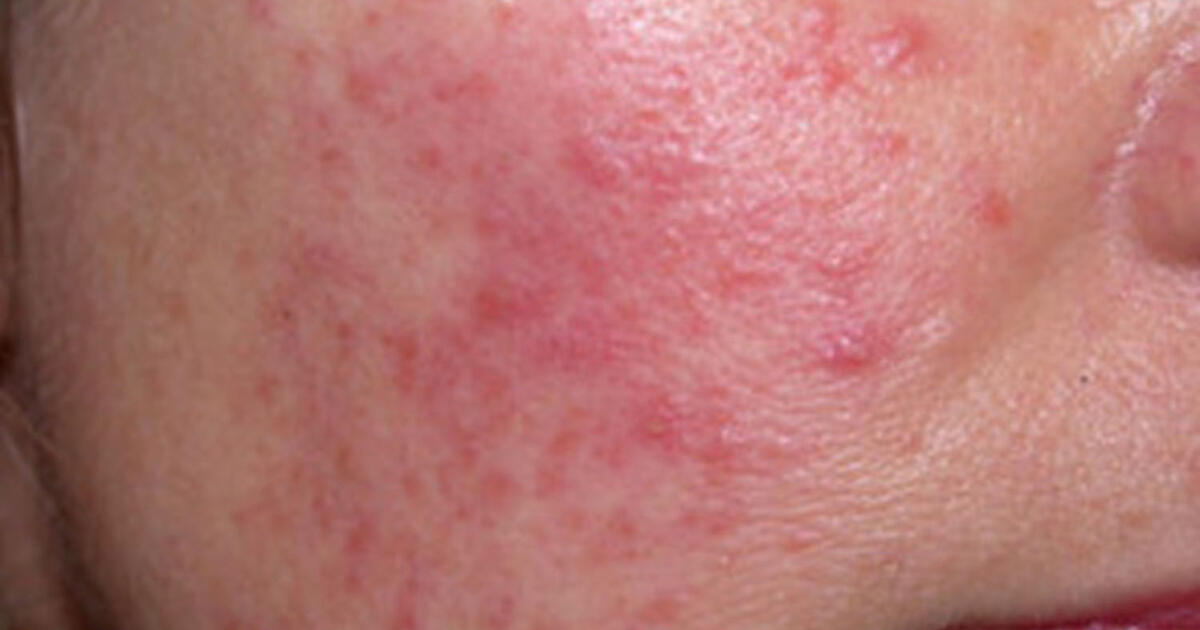 Rožinė. Kas tai per liga ir kaip elgtis pasireiškus simptomams?