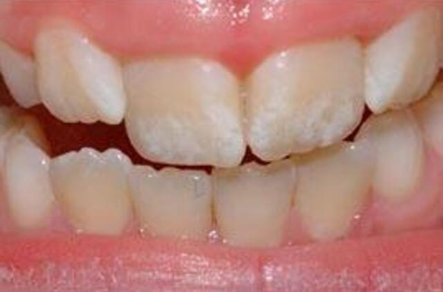 Atlikti dantų fluorozės tyrimai